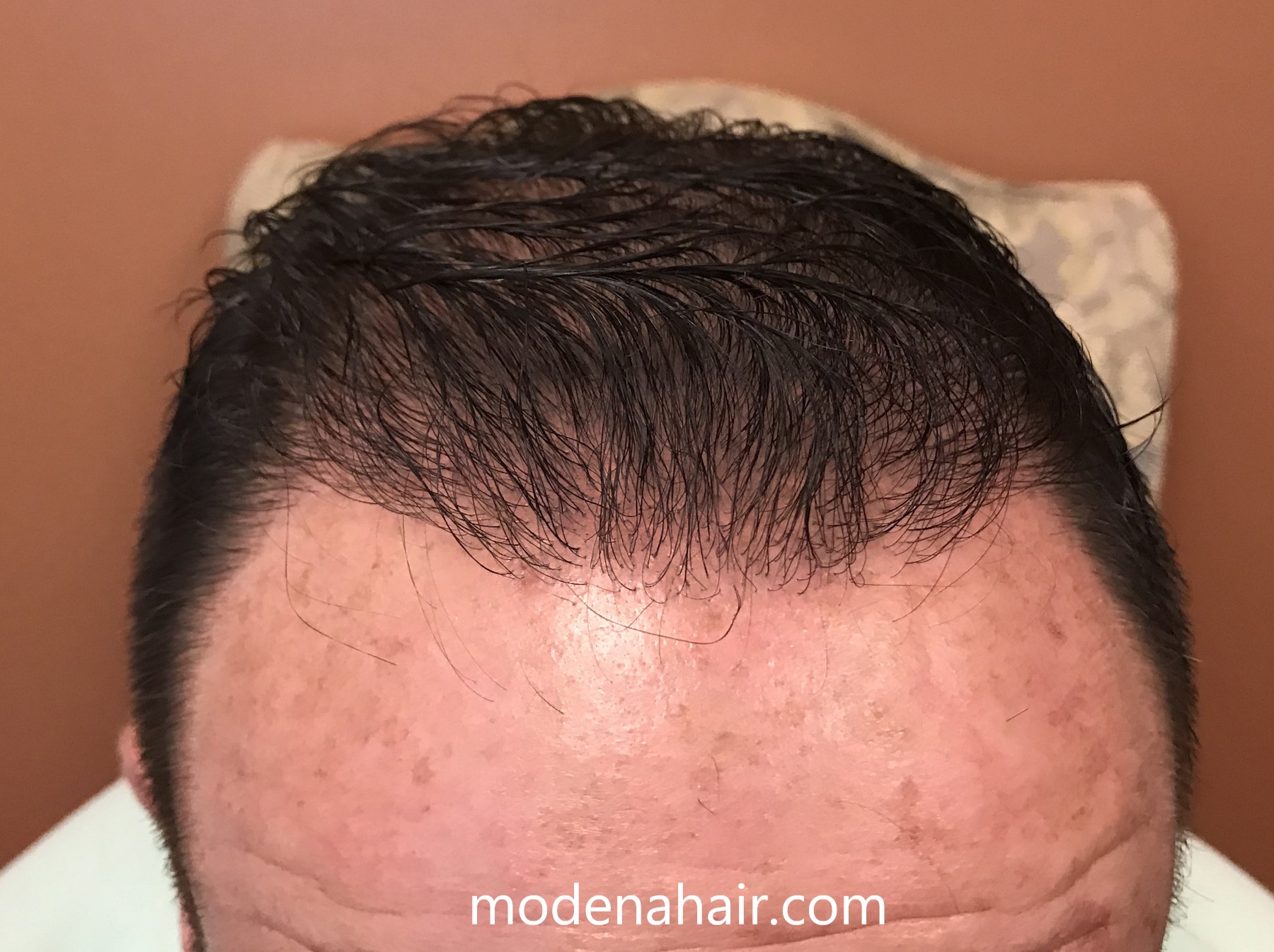 Case Study - FUE Hairline Hair Transplant - Modena Hair Institute