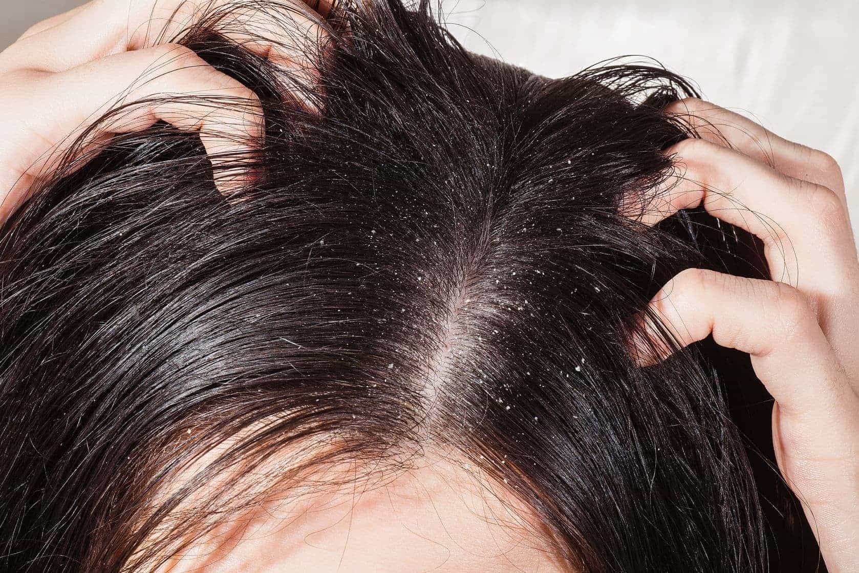 Which One of These is Causing Your Scalp Irritation? - Modena Hair ...
