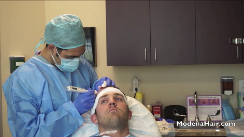 FUT Procedure, Step by Step - Modena Hair Institute