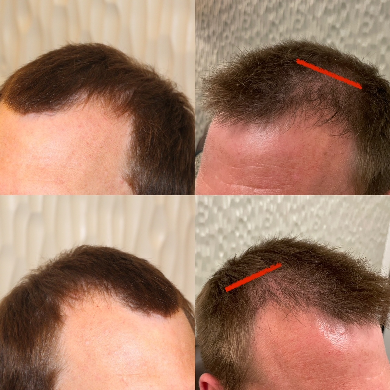 34 yr old male FUE - Filling in Hairline - 1517 Grafts