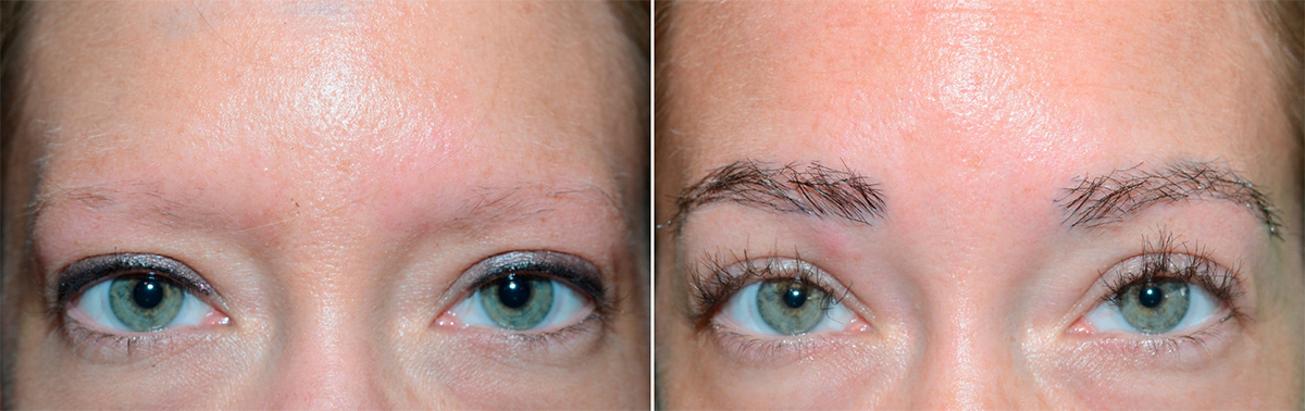 Claire's New Eyebrows (Case Study) - Modena Hair Institute