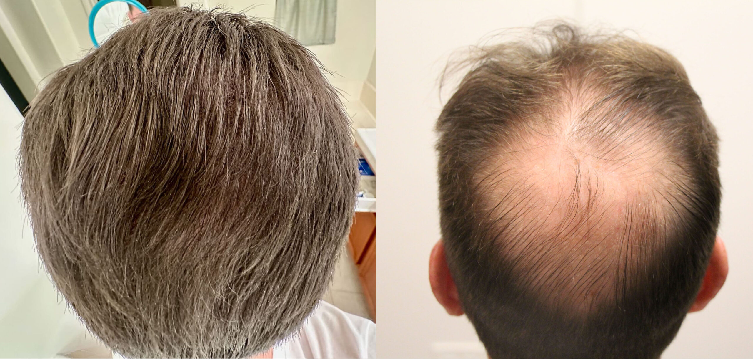 40 yr. old Male Crown Hair Transplant FUE - Modena Hair Institute